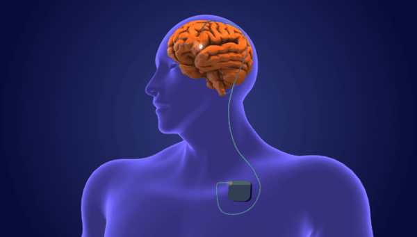 Seven Things to Know About Recovering from Deep Brain Stimulation ...