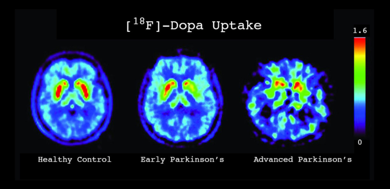 DaTscan: What It Is, How It Works, and What It Can Tell You - Davis ...
